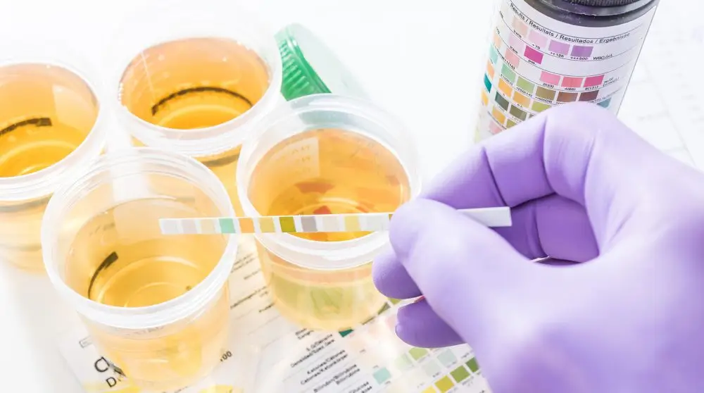 Understanding Proteinuria and Its Impact on Kidney Health - Kidney ...